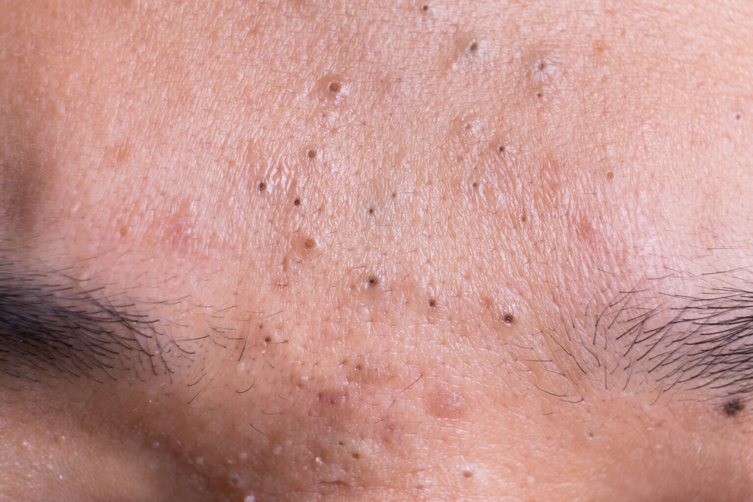 Akne Behandlung in Mainz - Hautarztpraxis Dr. Kirschner